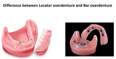What Is The Difference Between Bar Overdenture And Locator Overdenture News Dentagama