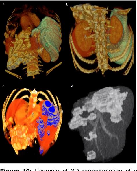 Figure 10 From Automatic Liver Segmentation On Computed Tomography