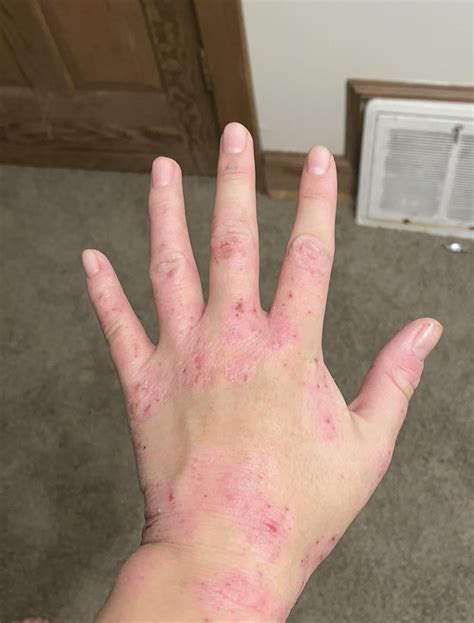 Adbry Progress 2 1 2 Months R Eczemabs