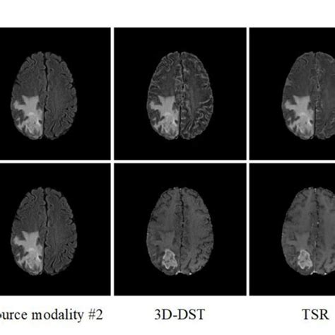Figure Examples Of Brain Tumor Segmentation Results Obtained By