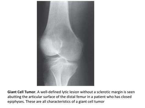 Lytic Lesions Of Bone Pptx