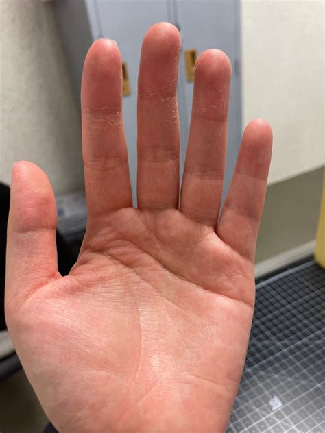 손바닥 피부 각질 지식in