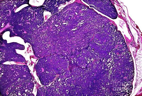 Thyroid Adenomatous Hyperplasia By Science Photo Library