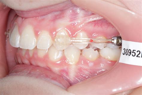 Dental News Boosting Facial Aesthetics Through A Hybrid Approach Of