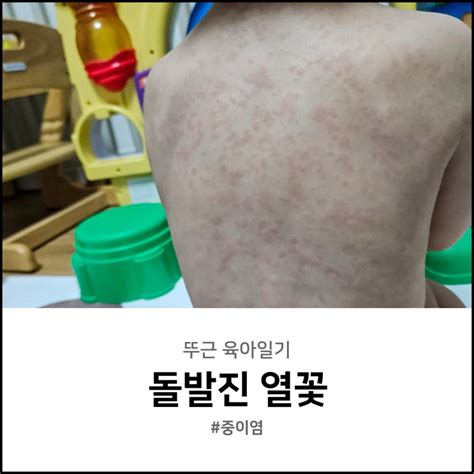 아기 돌발진 열꽃 콧물 중이염 일주일의 기록 네이버 블로그