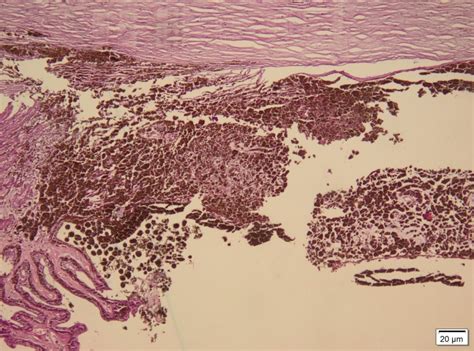 [figure Iris Melanoma Markers Iris Melanoma ] Statpearls Ncbi