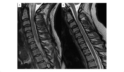 Sagittal T2 Of The Cervical Spine Showed An Abnormal T2 Hyperintense