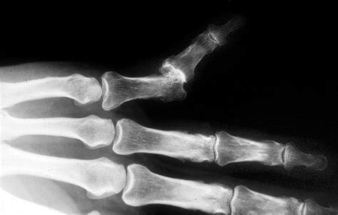 Dislocation Finger Proximal Interphalangeal Pip Joint Hand Surgery