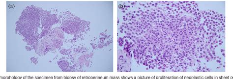 Figure 1 From Mast Cell Sarcoma Of The Retroperitoneum With Concurrent Systemic Mastocytosis And