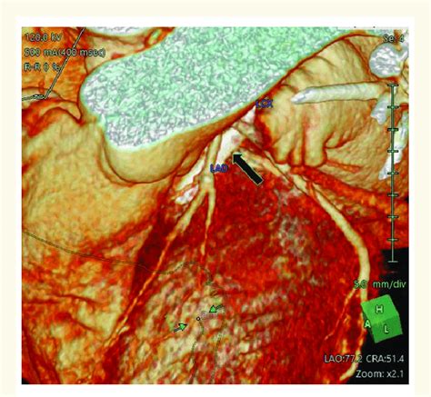 3d Volume Rendering Reconstructions Showing The Distal End Of The Download Scientific Diagram