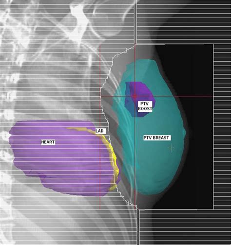 beam s eye view demonstrating tangential field shaping using multi leaf