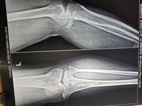Comminuted Proximal Tibia Fracture With Metaphyseal Extension