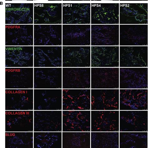 Pdf Modeling Of Fibrotic Lung Disease Using 3d Organoids Derived From