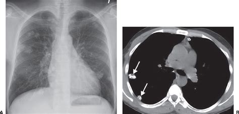 What Is A Calcified Nodule In The Lung
