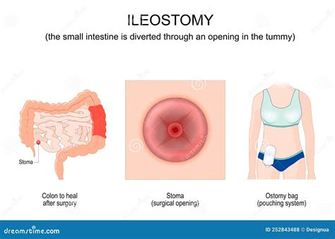 Ileostomy