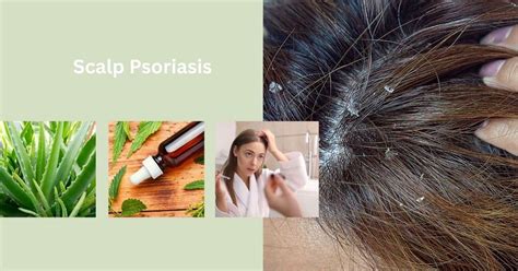 Scalp Psoriasis Faasha
