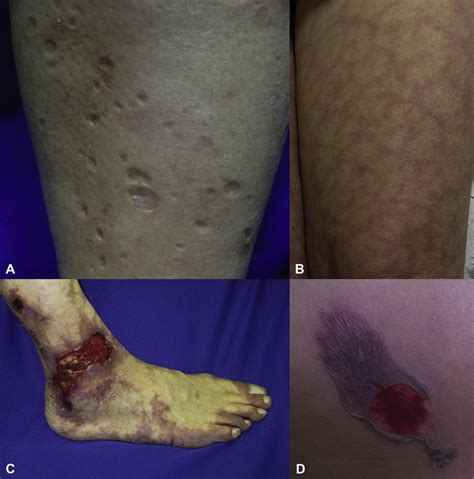 The Skin And Hypercoagulable States Journal Of The American Academy Of Dermatology