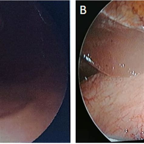 A Endoscopic View Of A Gastric Gist In A 66 Year Old Patient B