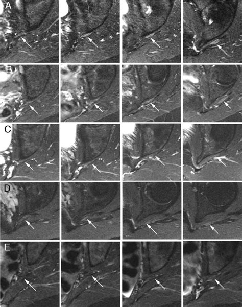 Comparison Of Sciatic Nerve Appearance At The Sciatic Notch In Patients Download Scientific