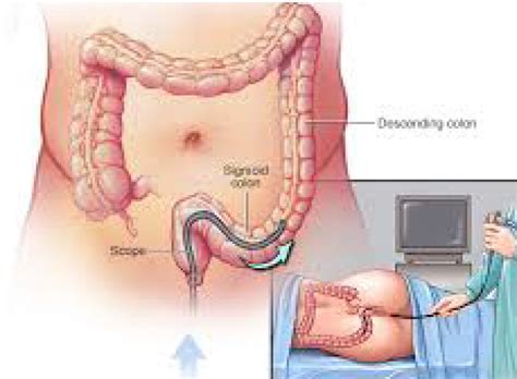 About Sigmoidoscopy Test Cscr Hospital And Diagnostic Chittagong