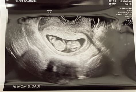 Ftm With Surprise Twins R Parentsofmultiples