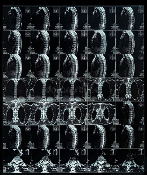 Scoliosis Film X Ray Show Spinal Bend In Teenager Stock Image Image Of Joint Background