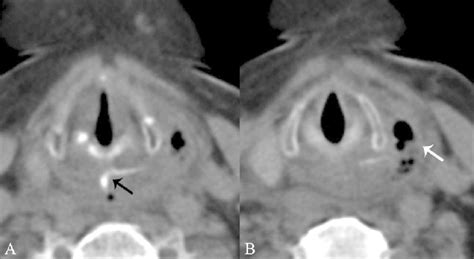 A B Noncontrast Axial CT Scans Show A Curvilinear FB Black Arrow Download Scientific
