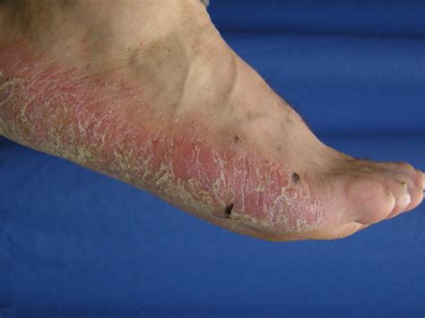 Palmar Plantar Psoriasis Photos