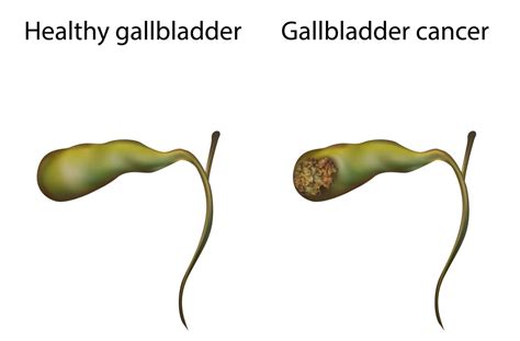 Gallbladder Cancer Treatment Gallbladder Surgeon