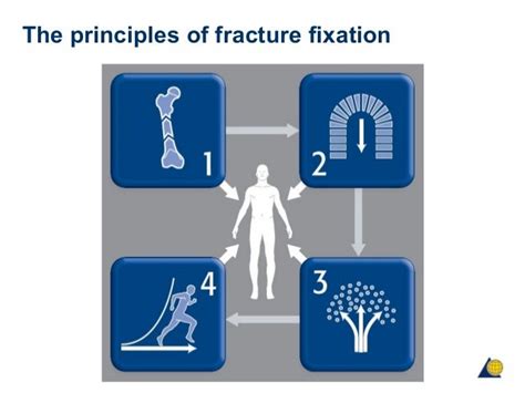 Principles Of Fracture Fixation