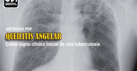 Pdf Queilitis Angular Como Signo Clínico Inicial De Una Tuberculosis Ovi Dental