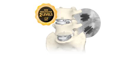 New CPT Code Now Effective For Second Level Of Lumbar Total Disc Replacement Procedures Ortho