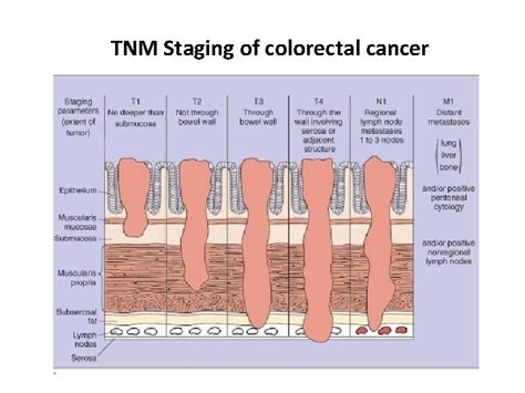 Colorectal Mcqs Tnm Staging Of Colorectal Cancer Yp