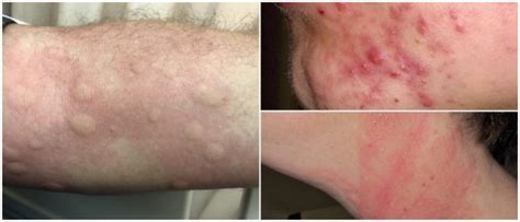 Urticarial Rash