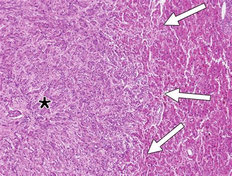 Cholangiocarcinoma Pathology Outlines