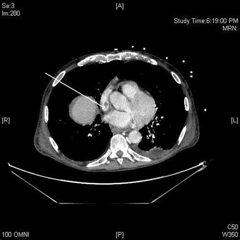Ultrasound Detection Of Superior Vena Cava Thrombus The Western