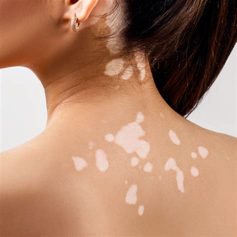 What Is Vitiligo Simcoderm