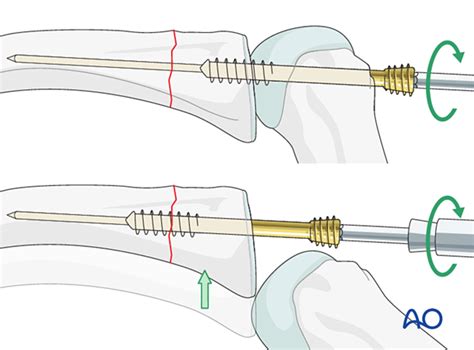 Intramedullary Screw Fixation For Transverse Extraarticular Fracture Of The Proximal End Segment