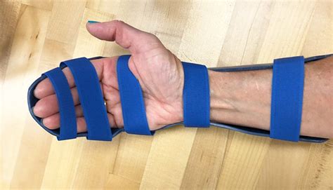 Dorsal Blocking Orthosis For Flexor Tendon Rehabilitation Orthosis Rehabilitation Hand Therapy