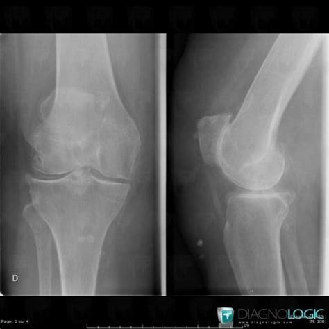 Radiology Case CPPD X Rays Diagnologic