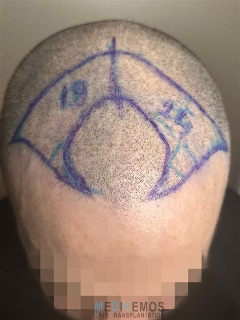 Dr Lupanzula E Medikemos Clinic 2327 Follicular Units Fue Front