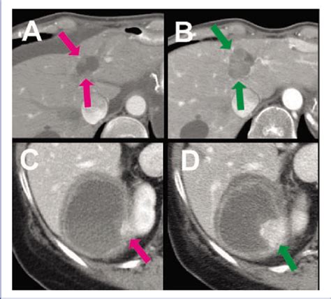 Gist Progression During Imatinib Download Scientific Diagram