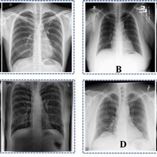 PDF Reliable Tuberculosis Detection Using Chest X Ray With Deep Learning Segmentation And