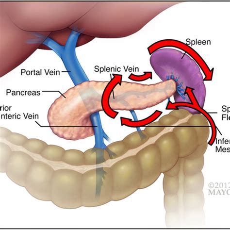 Technique And Audited Outcomes Of Laparoscopic Distal Pancreatectomy Combining The Clockwise