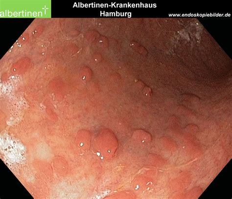 Colitis Ulcerosa Pseudopolypen Pfeile Doccheck