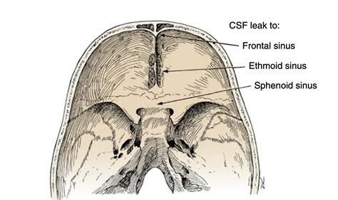 Imaging Cisternography For CSF Leak Detection