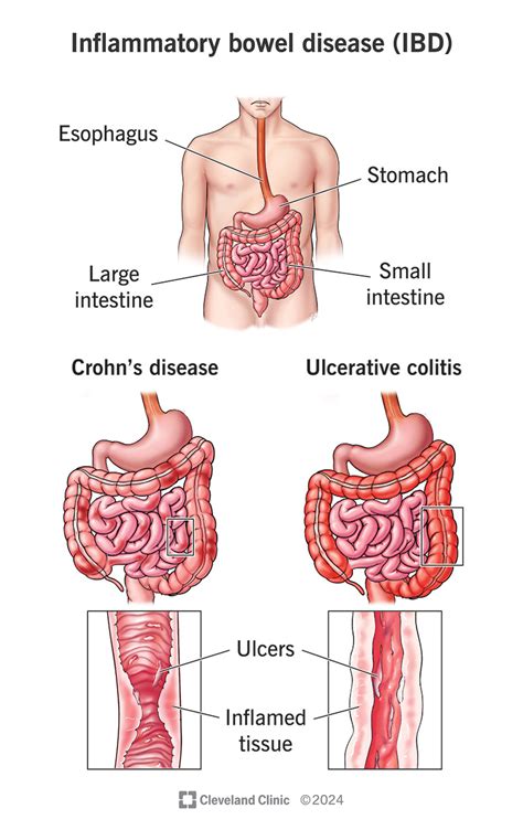 Inflammatory Bowel Disease Wikipedia The Pathophysiology Of