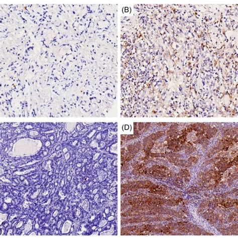 Pd L1 Ihc Staining Results With 200× Magnification In Each Histological