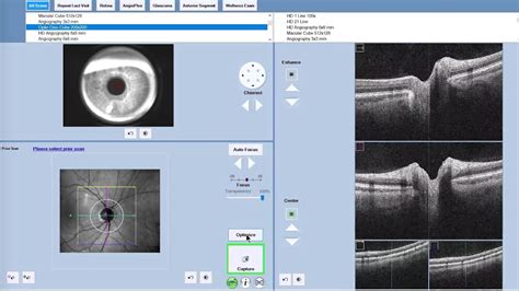 Optical Coherence Tomography Retina Center Of San Diego
