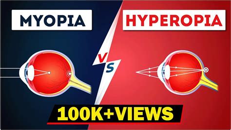 Difference Between Myopia And Hyperopia Near And Farsightedness Physics Letstute YouTube